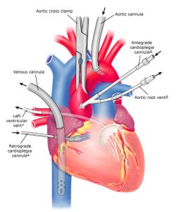 cardiac cannulas - GoharShafa